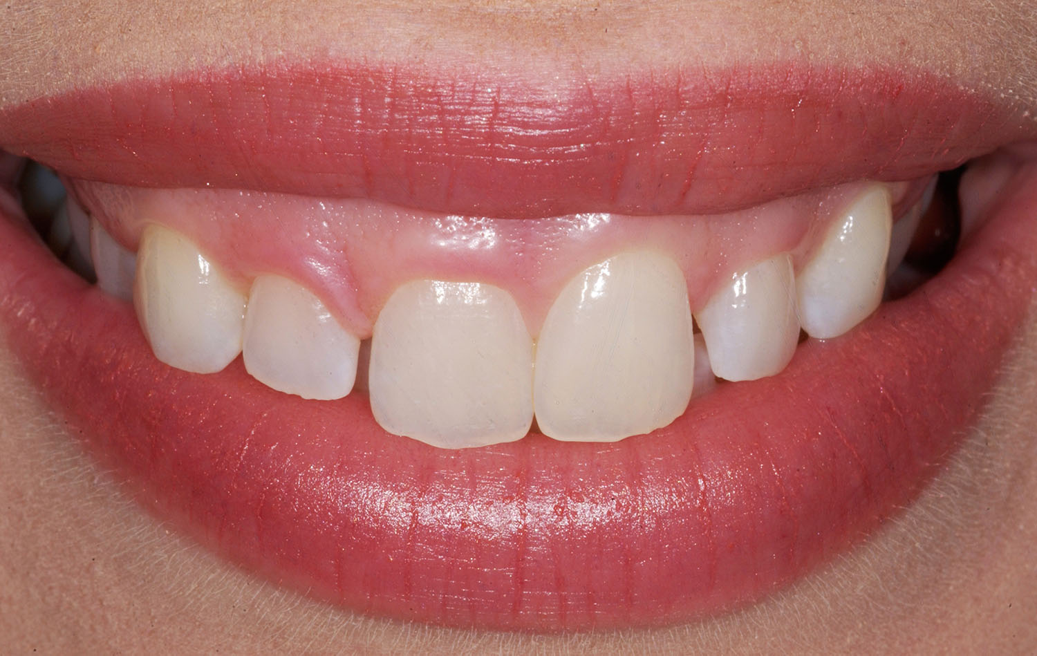 Dental Conditions We Treat at Bunker Hill Dentistry