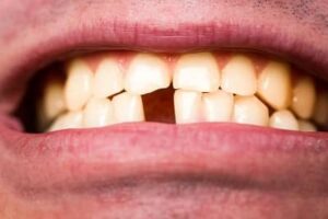 What to Do When an Adult Tooth Falls Out? Take These 4 Steps