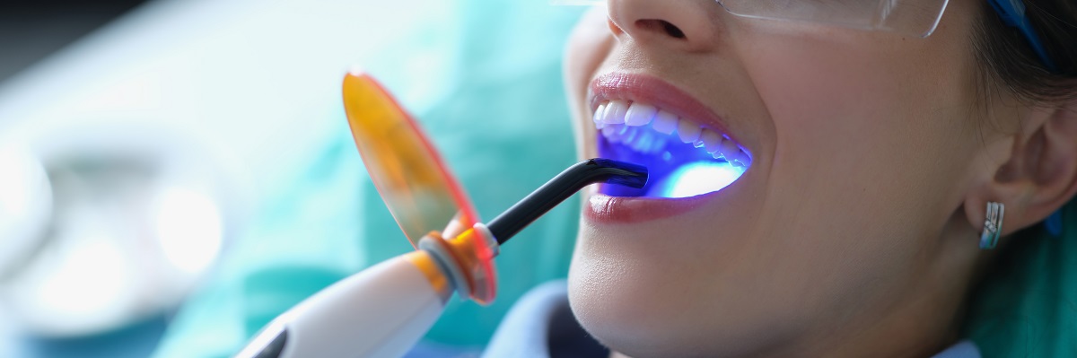 Is Dental Bonding Permanent? No. Can it Be Removed? Yes.