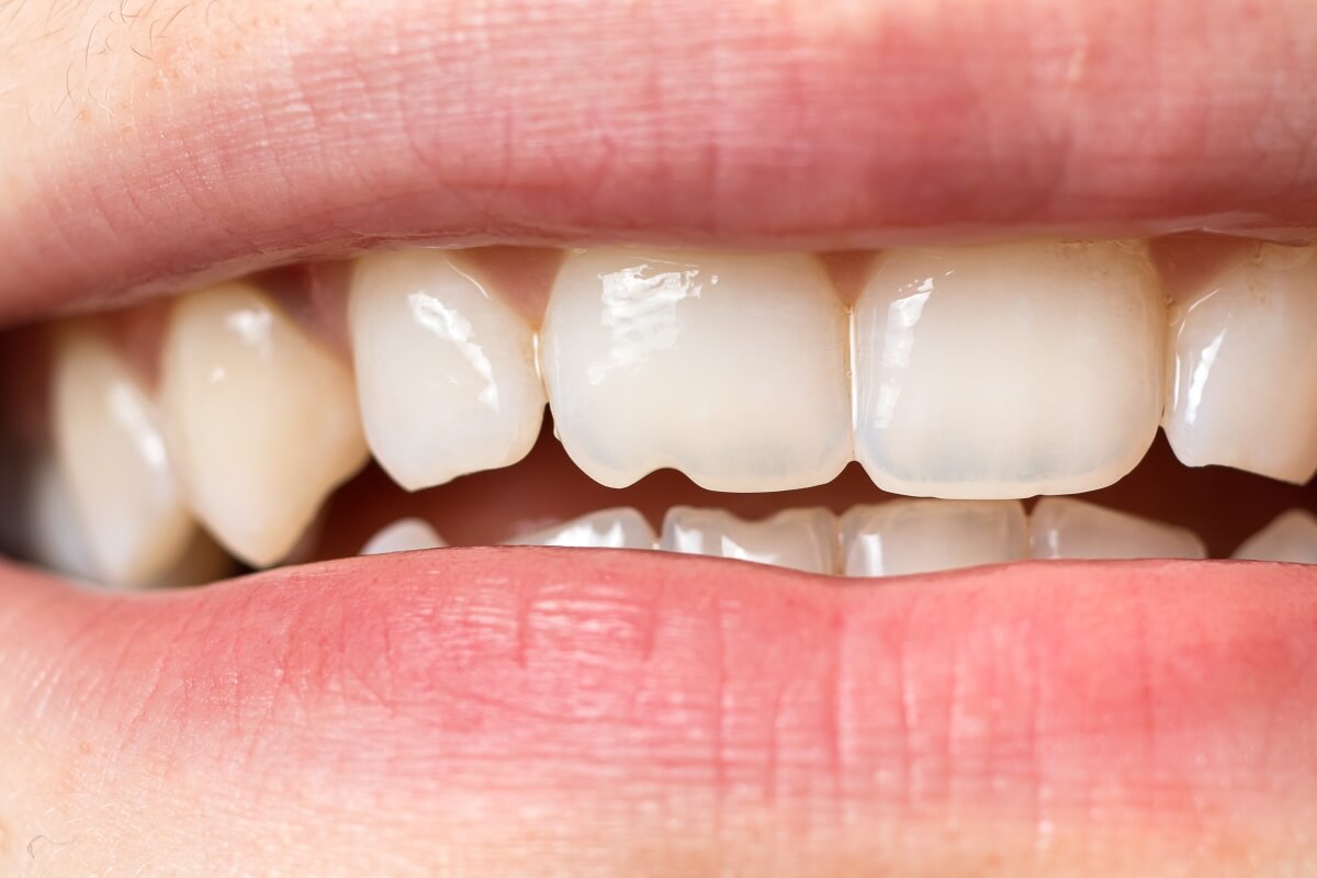 Chipped Tooth Repair & Treatment, Houston TX