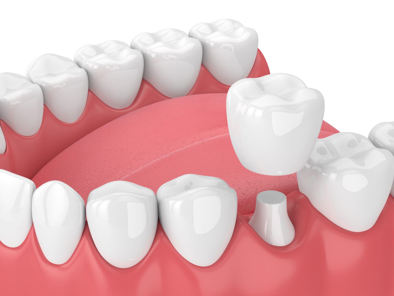 4 Alternatives to Dental Crowns & How to Choose the Right Option